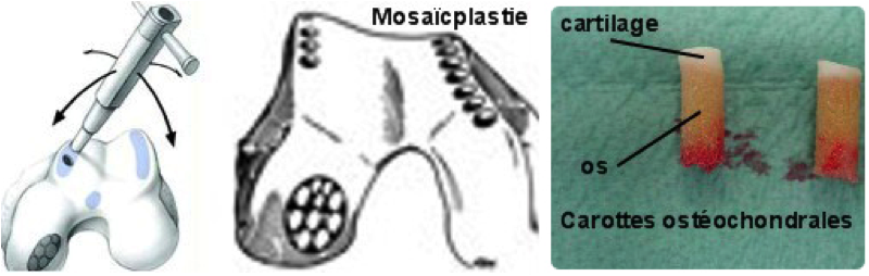 pathologie du cartilage du genou