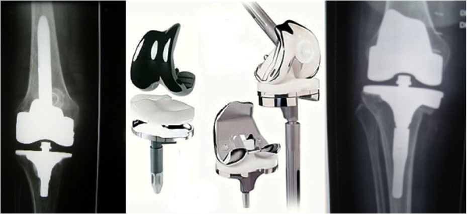 prothèse totale du genou